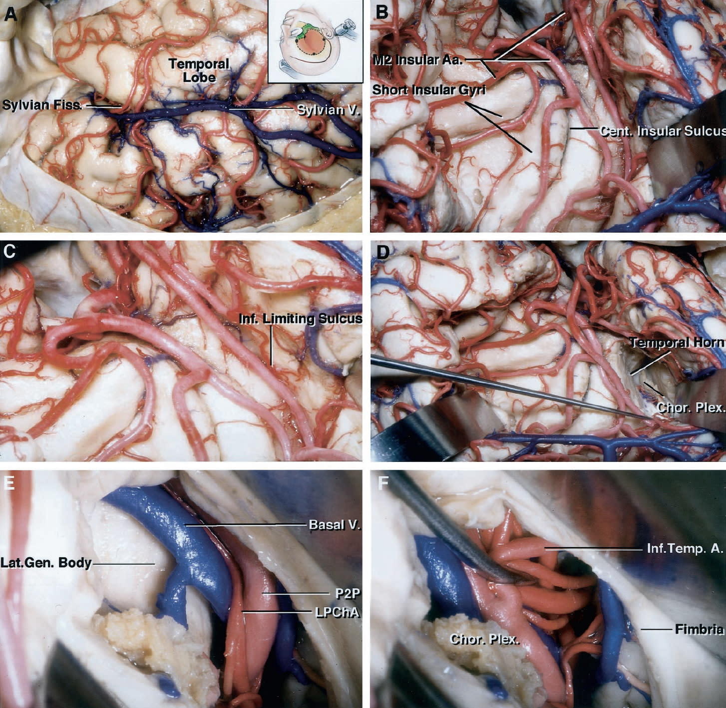 Transinsular Transchoroidal Approach to the Perimesencephalic Cisterns ...