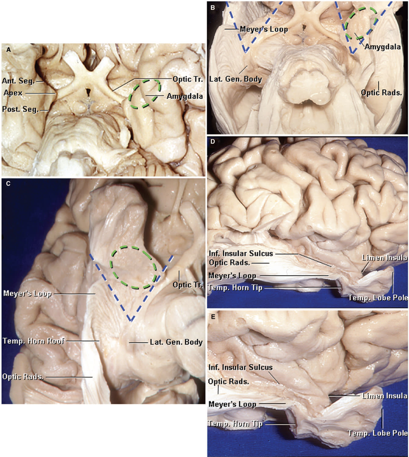 Inferior and Lateral Views of the Temporal Lobe and Optic Radiations ...