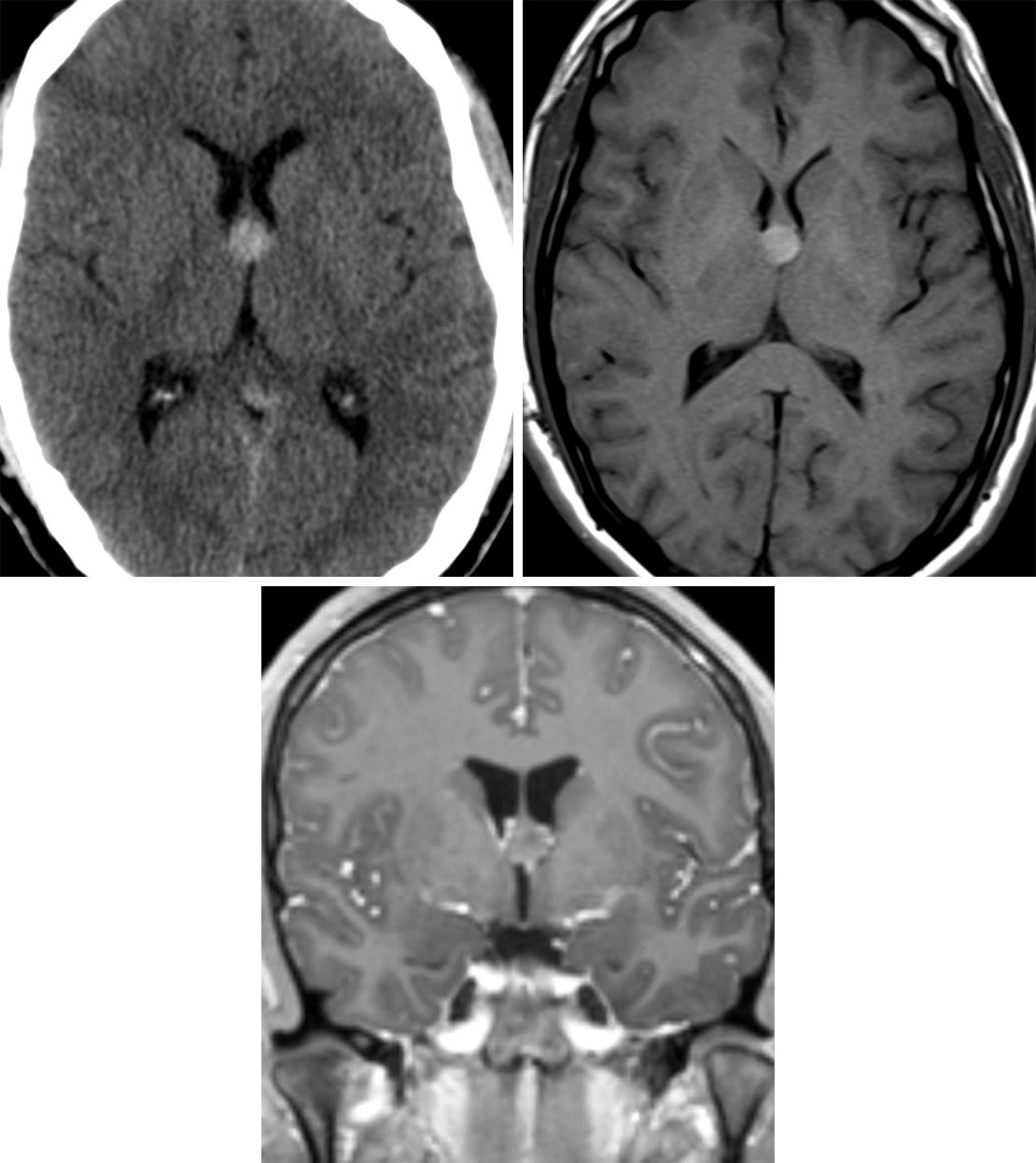 Colloid Cyst | Cohen Collection | Volumes | The Neurosurgical Atlas