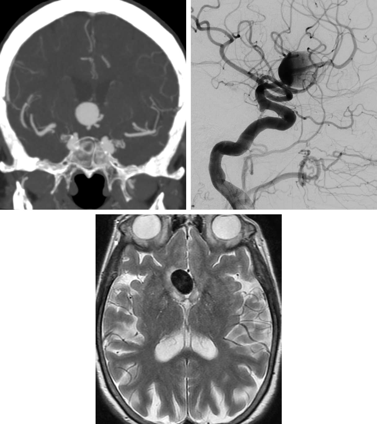 Imaging Evaluation of SAH and Aneurysm | Cohen Collection | Volumes ...