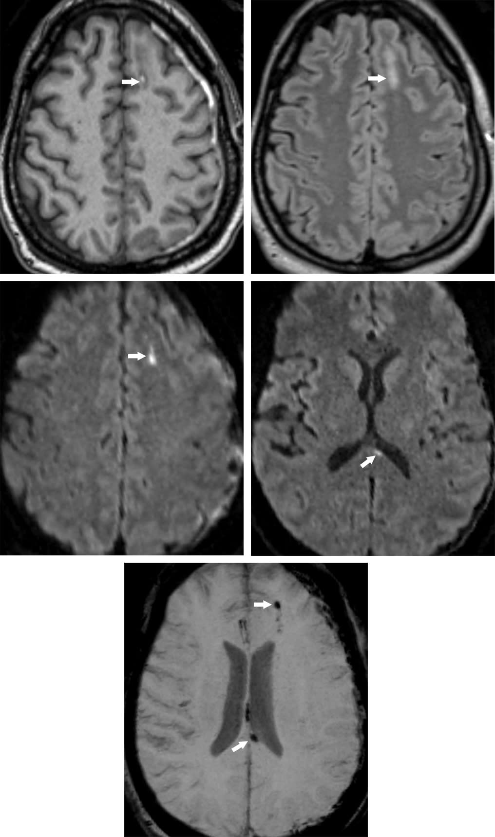 Diffuse Axonal Injury Mri