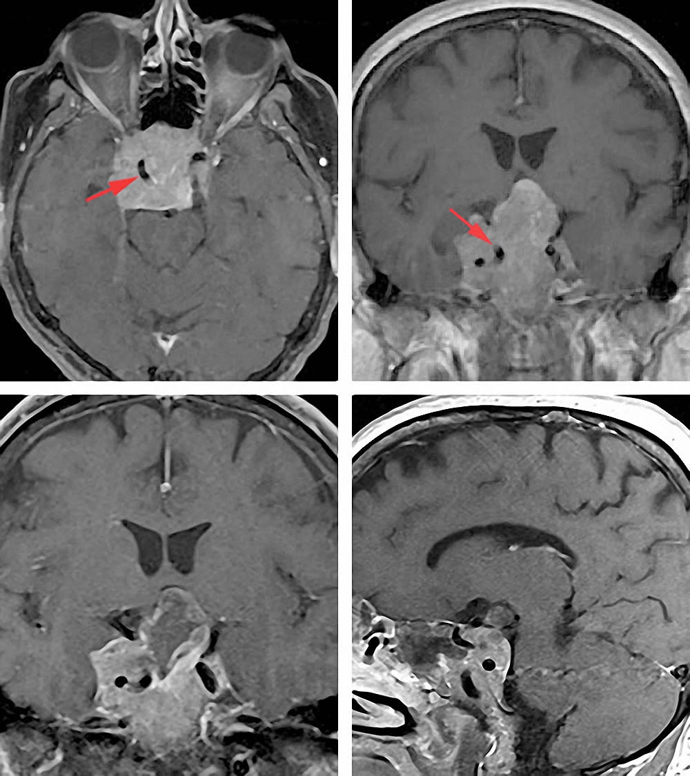 Microscope-Guided Endonasal Transsphenoidal Approach | Cohen Collection ...