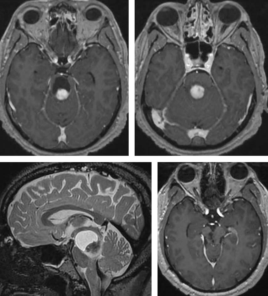 Posterior Mesencephalic and Pontine Pilocytic Astrocytoma | Cohen ...