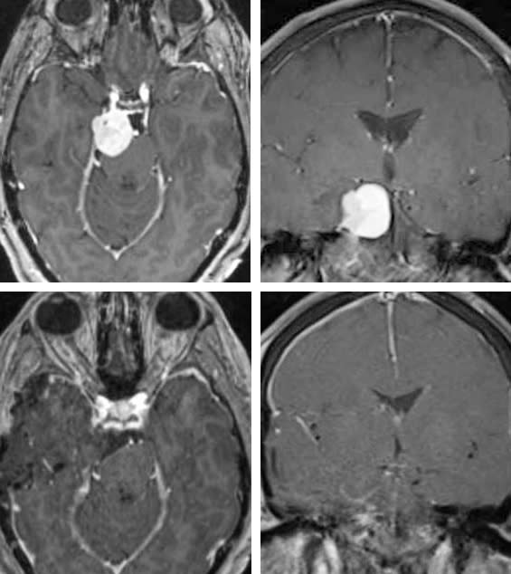 Anterior Petrosectomy | Cohen Collection | Volumes | The Neurosurgical ...