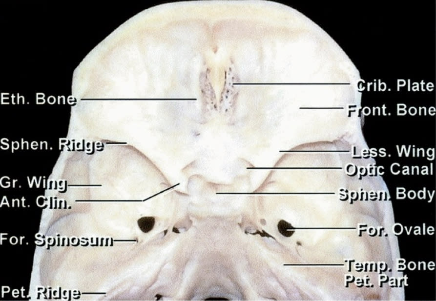 Medial Sphenoid Wing Meningioma | Cohen Collection | Volumes | The ...