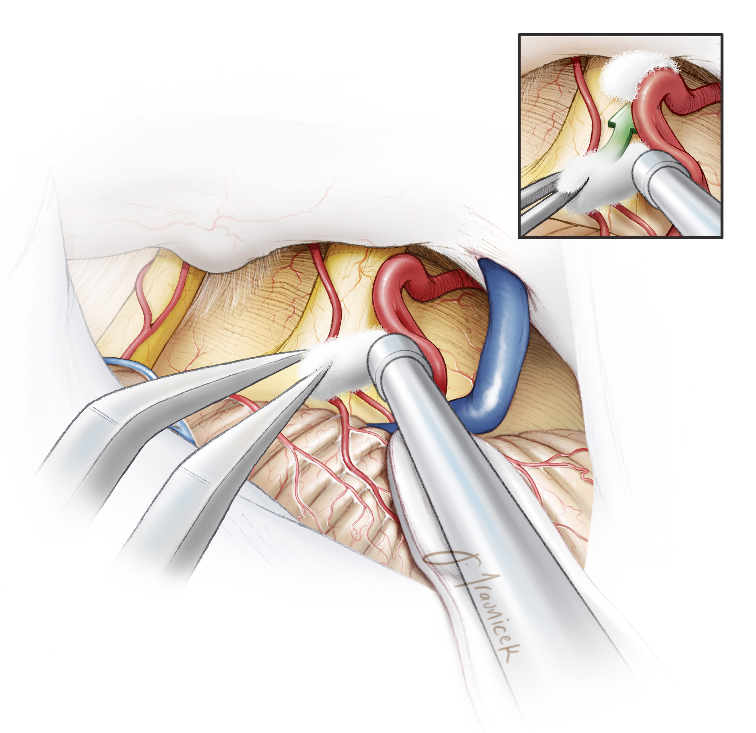 Microvascular Decompression for Trigeminal Neuralgia | Cohen Collection ...