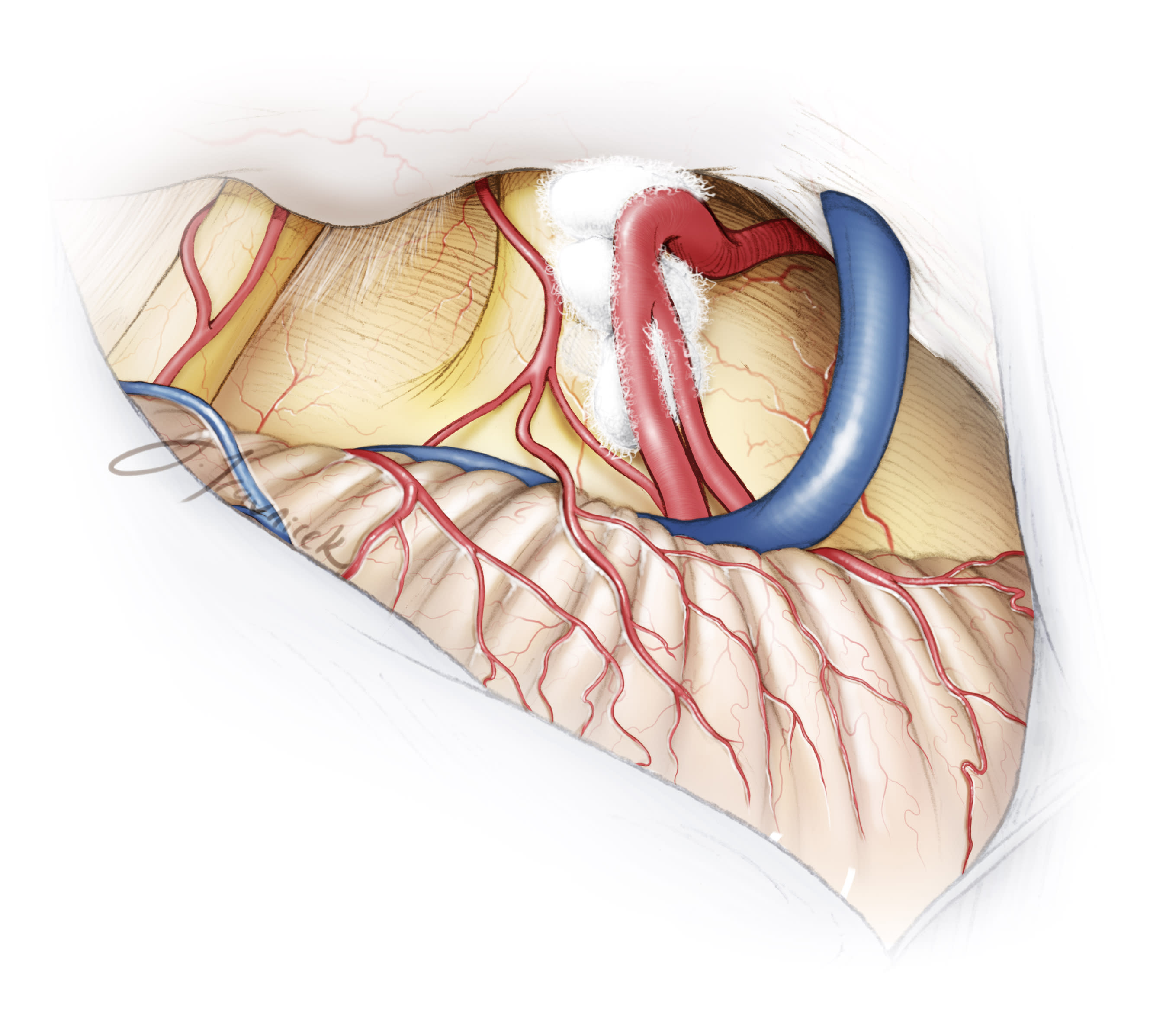 Microvascular Decompression for Trigeminal Neuralgia | Cohen Collection ...
