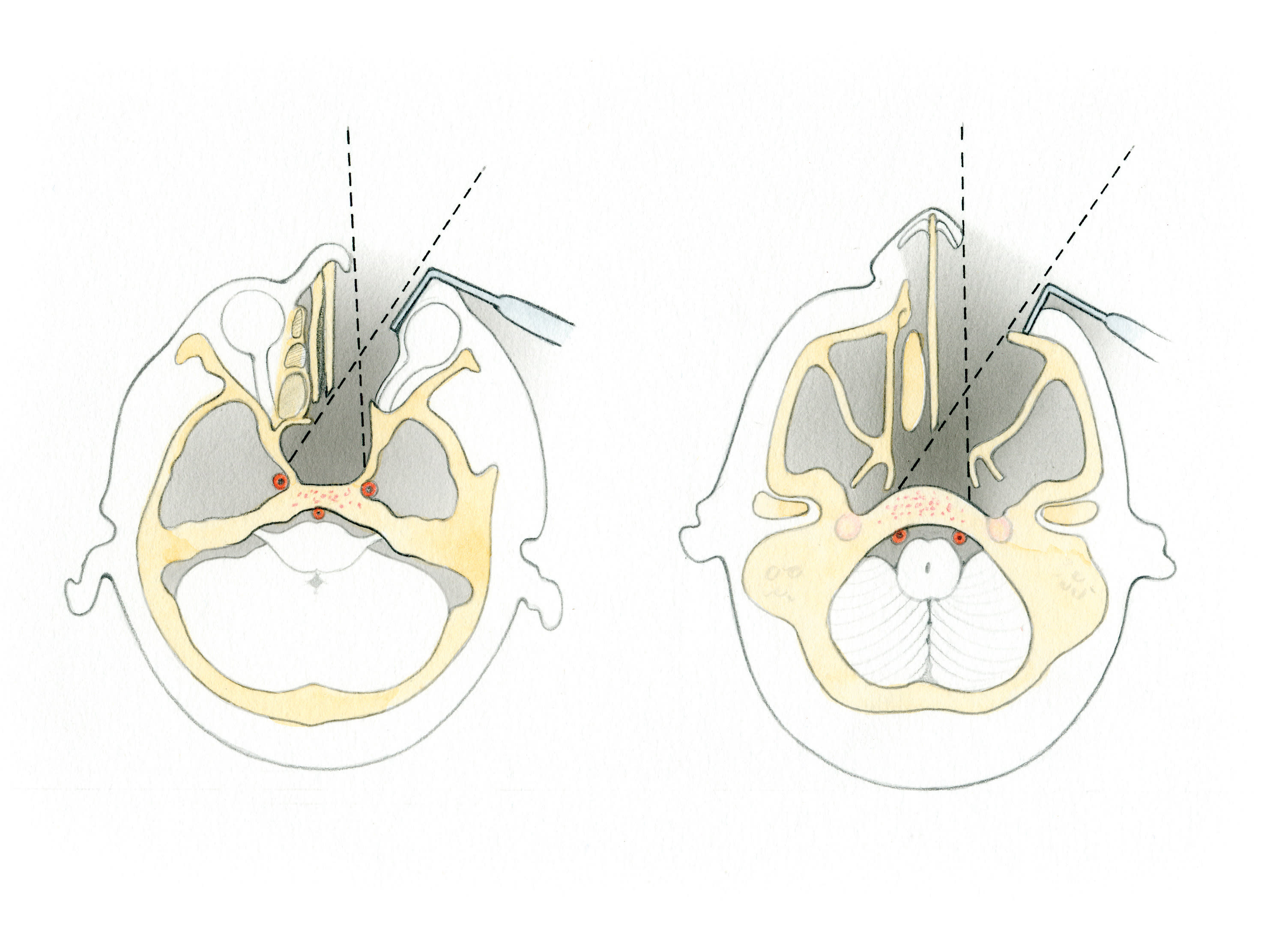 Anterior Approaches to the Clivus | Jackler Collection | Volumes | The ...