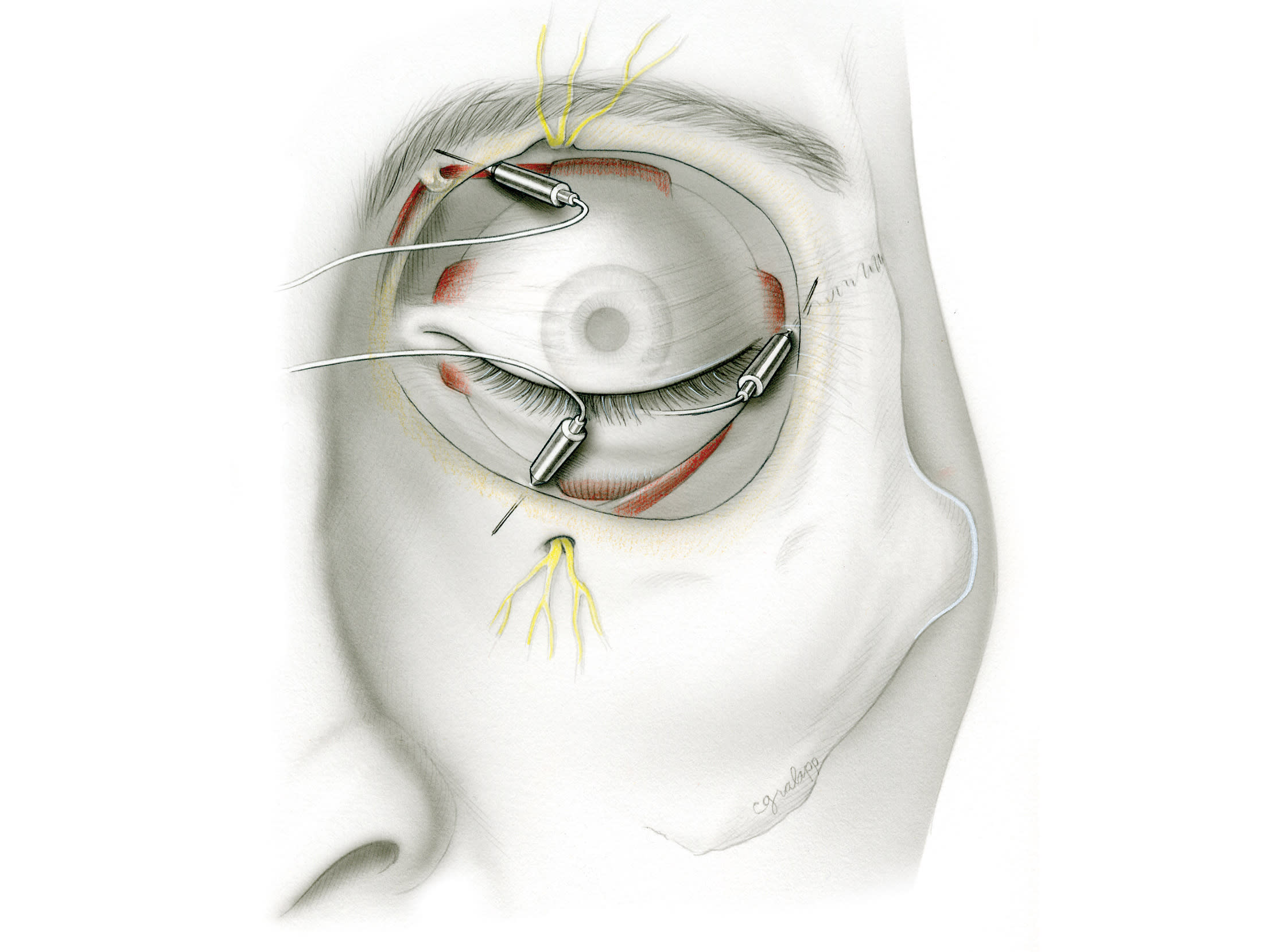 Cranial Nerve Monitoring | Jackler Collection | Volumes | The ...