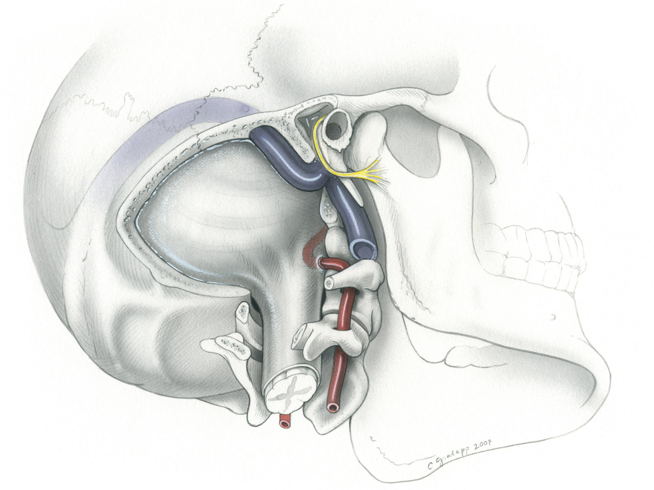 Far Lateral Approach to the Foramen Magnum | Jackler Collection ...