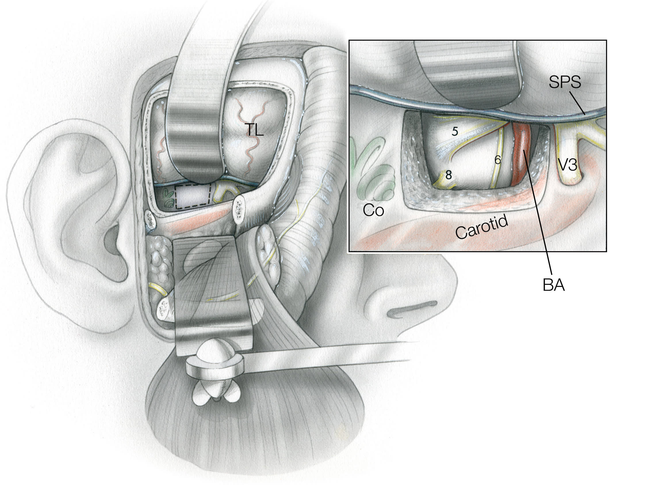 Middle Fossa Approach to Meckel's Cave | Jackler Collection | Volumes ...