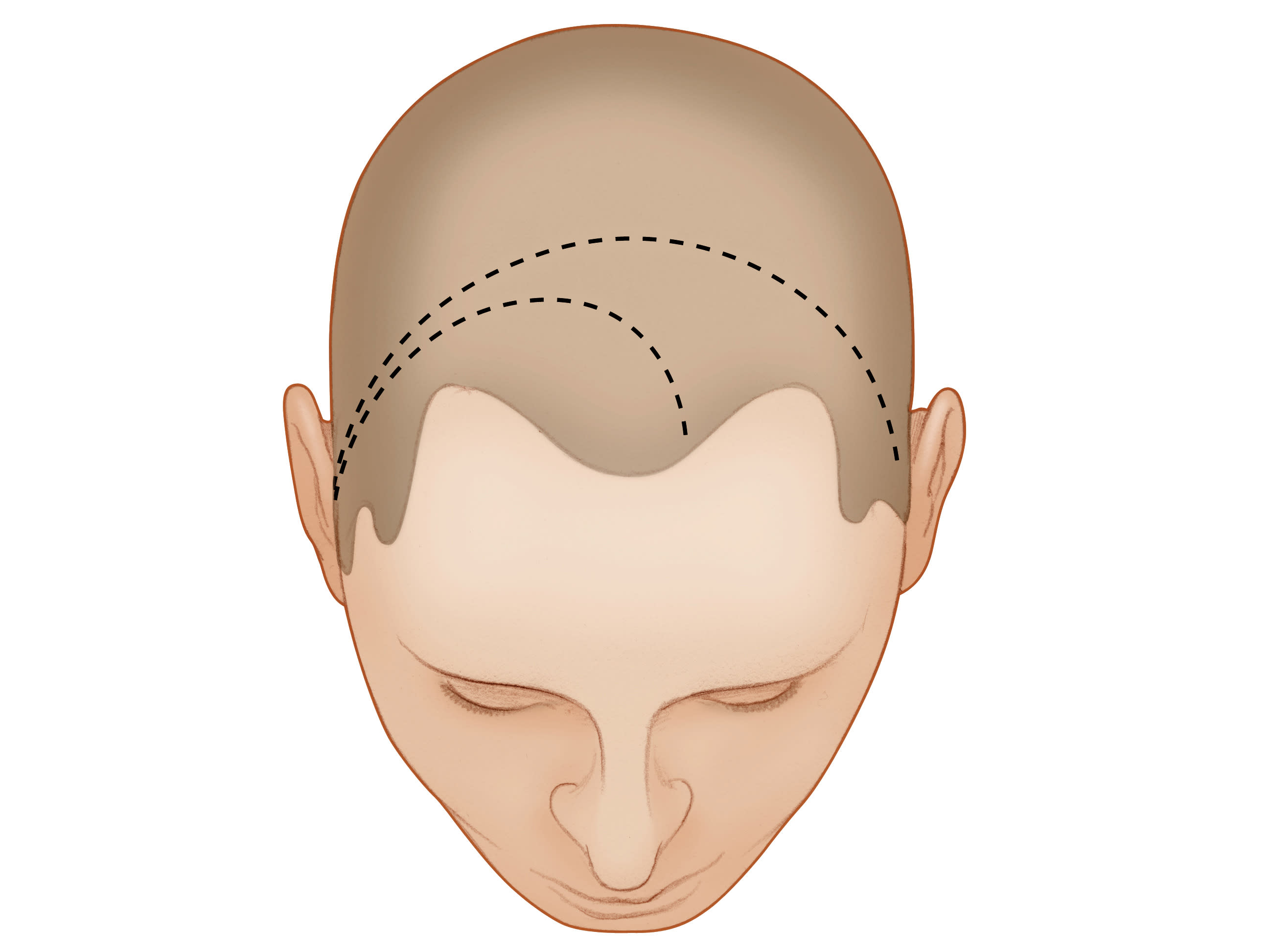 Orbitozygomatic Approaches | Jackler Collection | Volumes | The ...