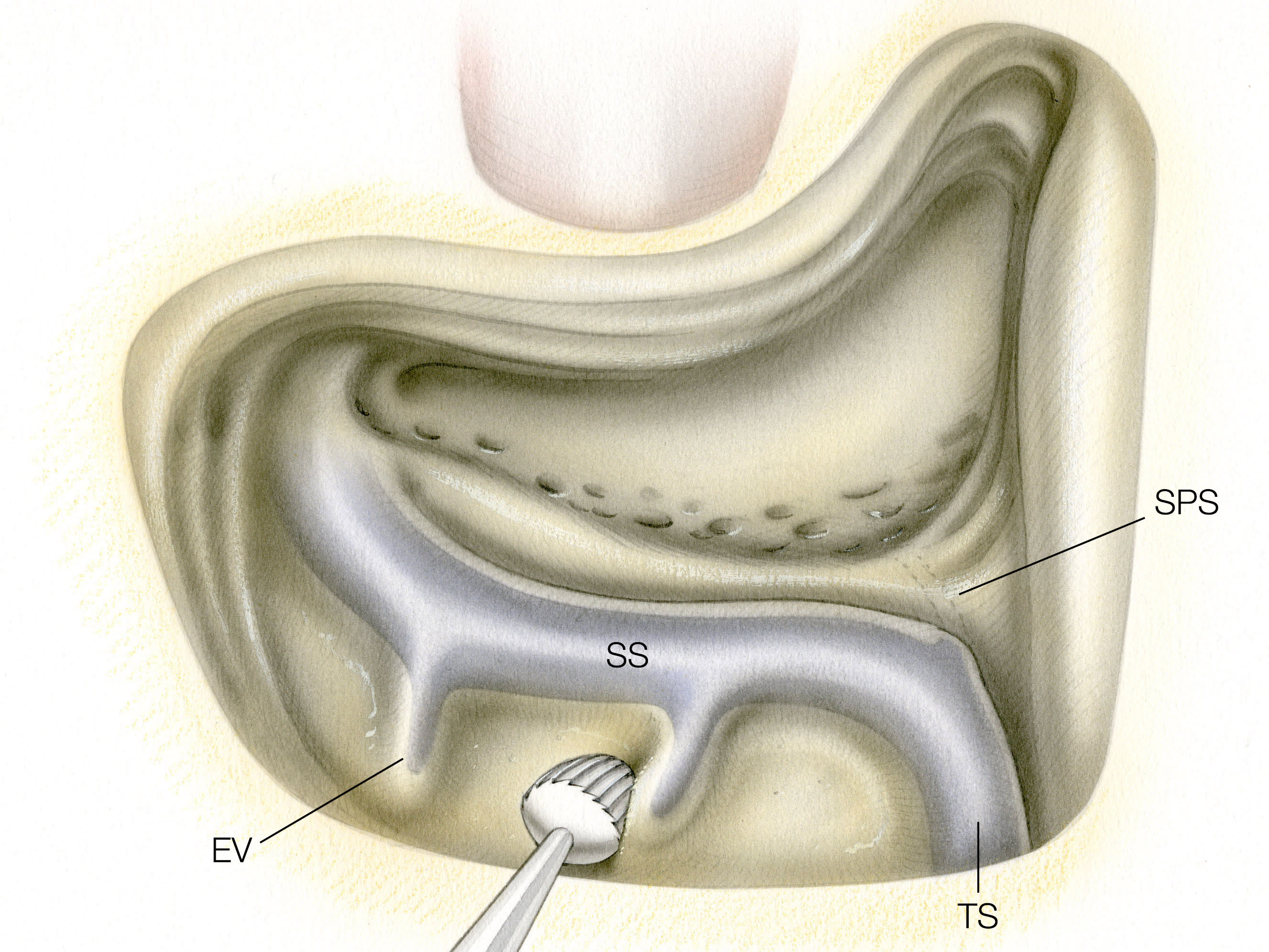 Translabyrinthine | Jackler Collection | Volumes | The Neurosurgical Atlas