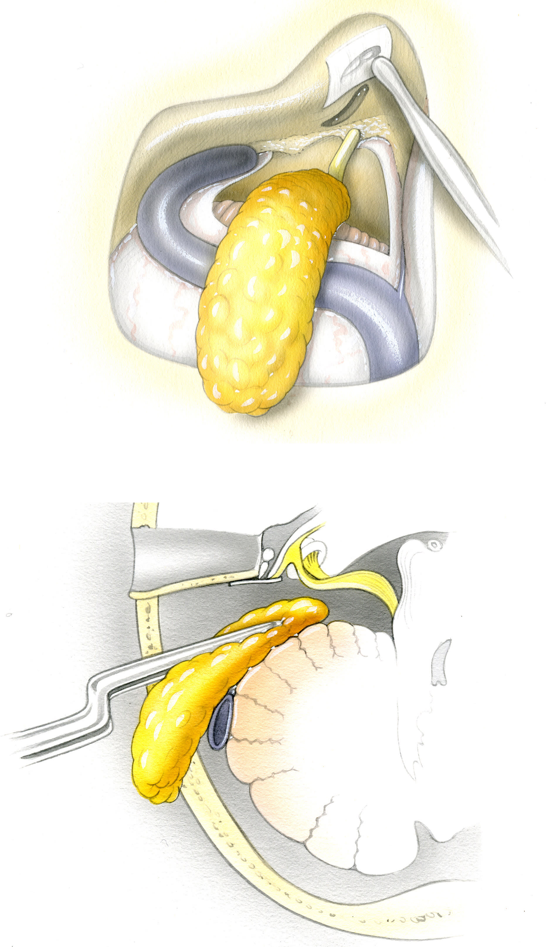 Translabyrinthine | Jackler Collection | Volumes | The Neurosurgical Atlas