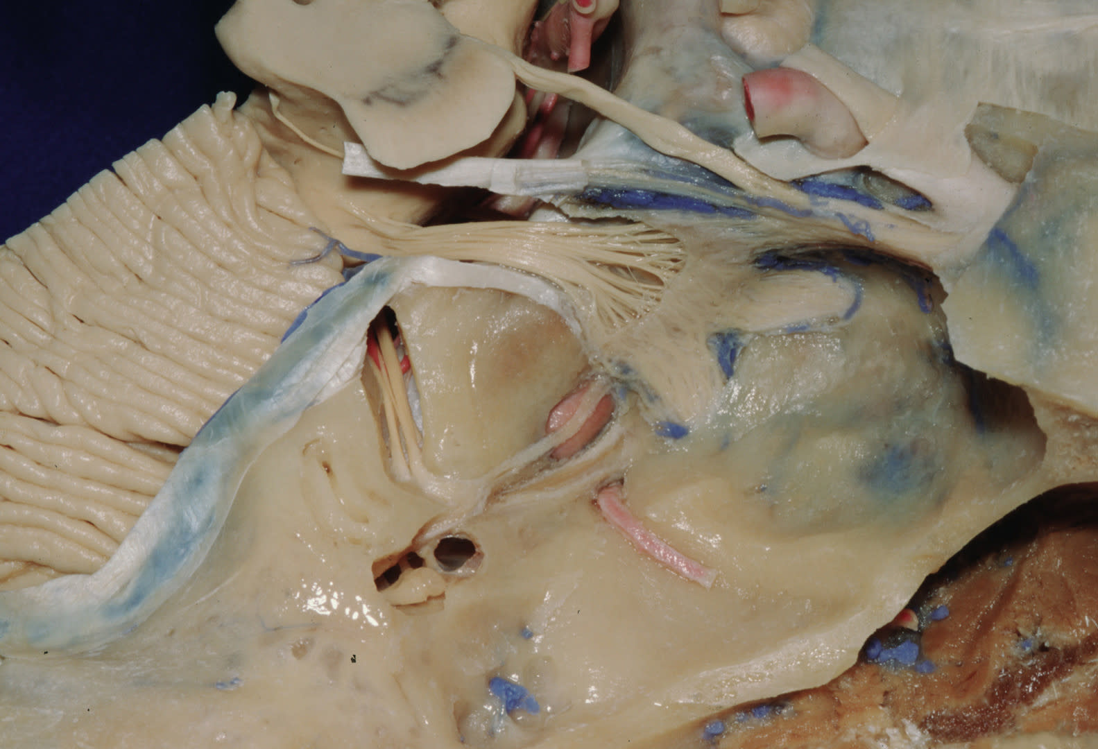 View of the Right Cavernous Sinus and Middle Cranial Fossa Floor ...