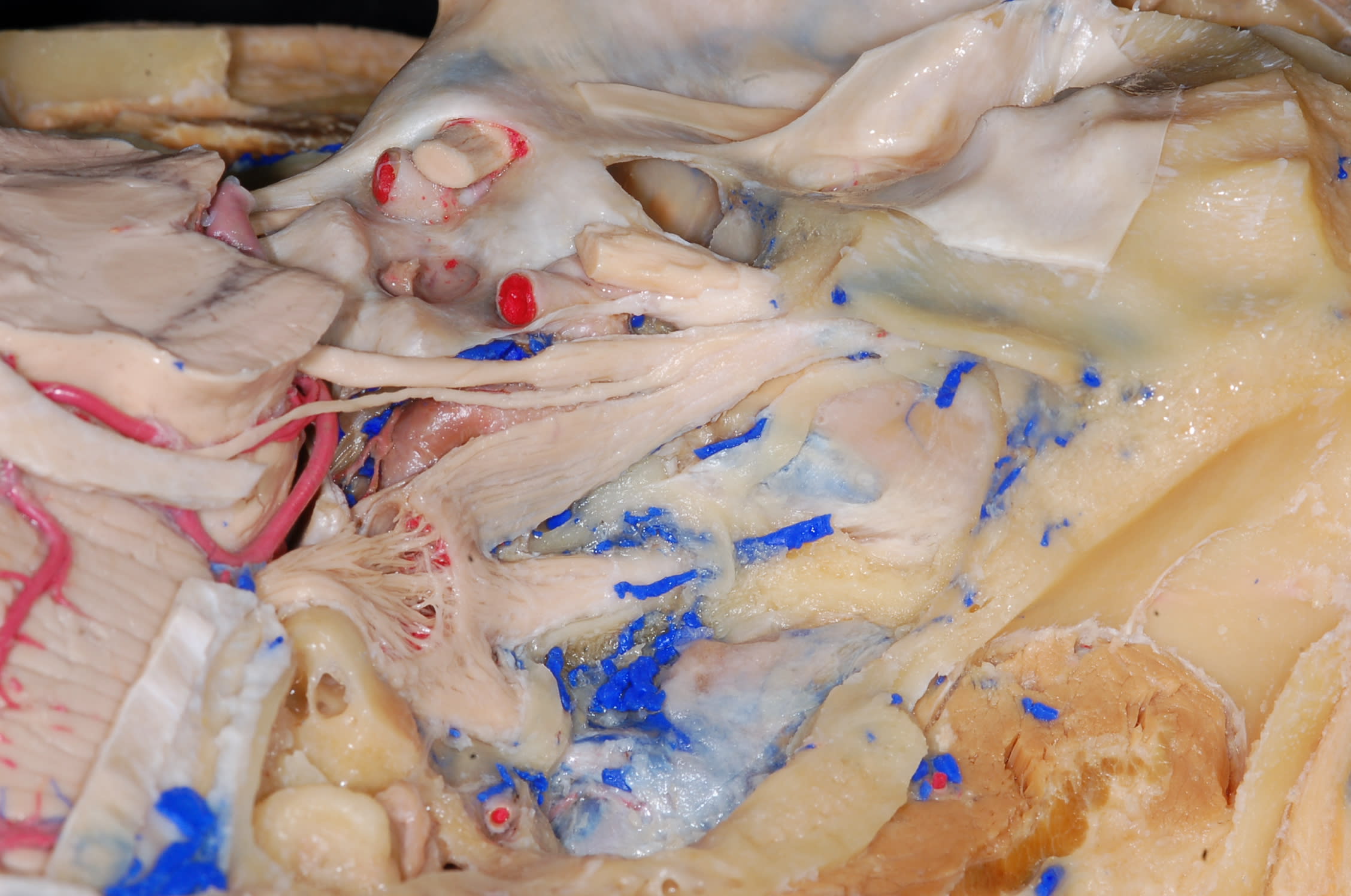 Right Superolateral View of Middle Cranial Fossa and Sellar Region ...