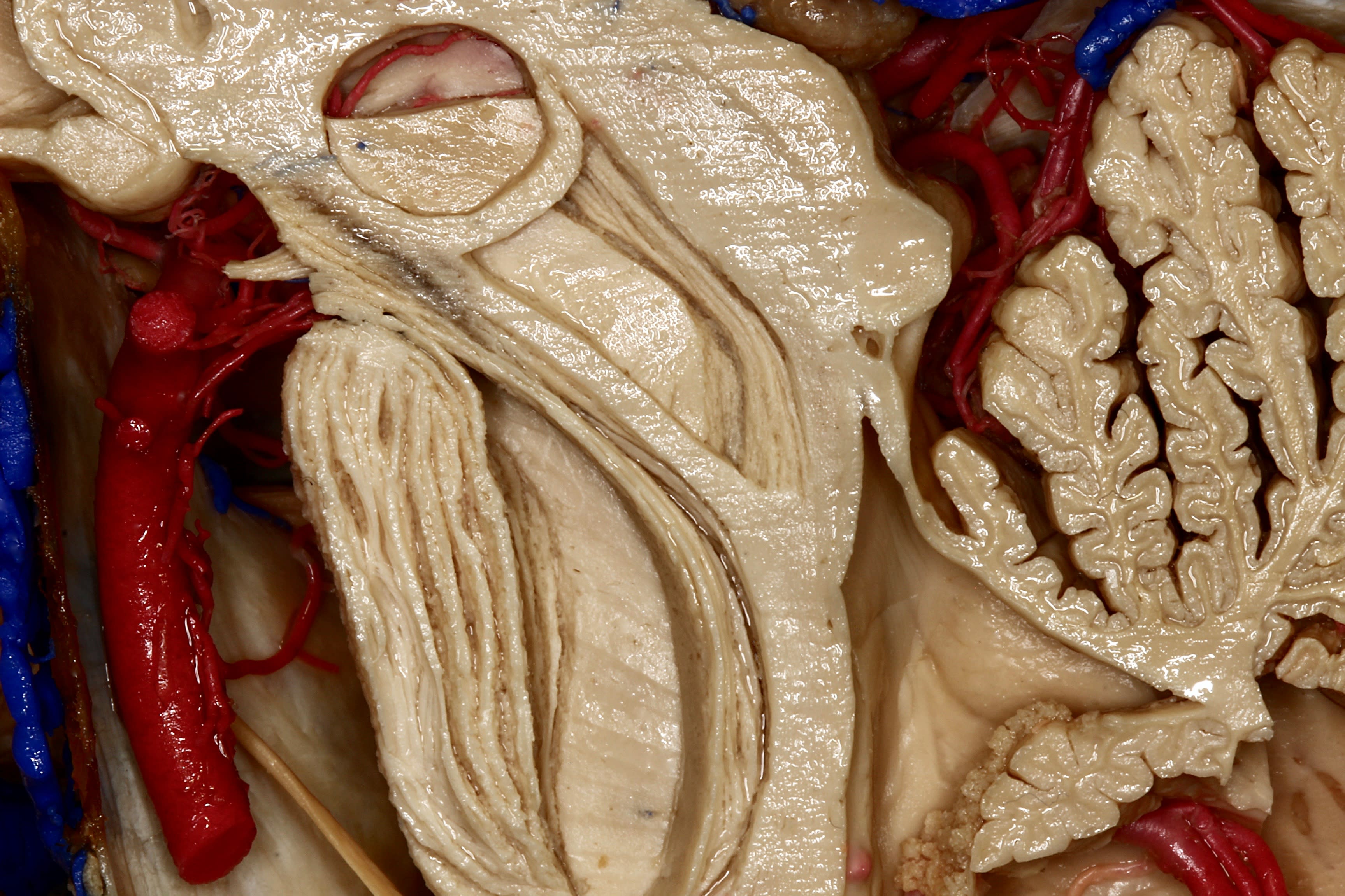 Midsagittal Perspective of Brainstem Dissection | Neuroanatomy | The ...