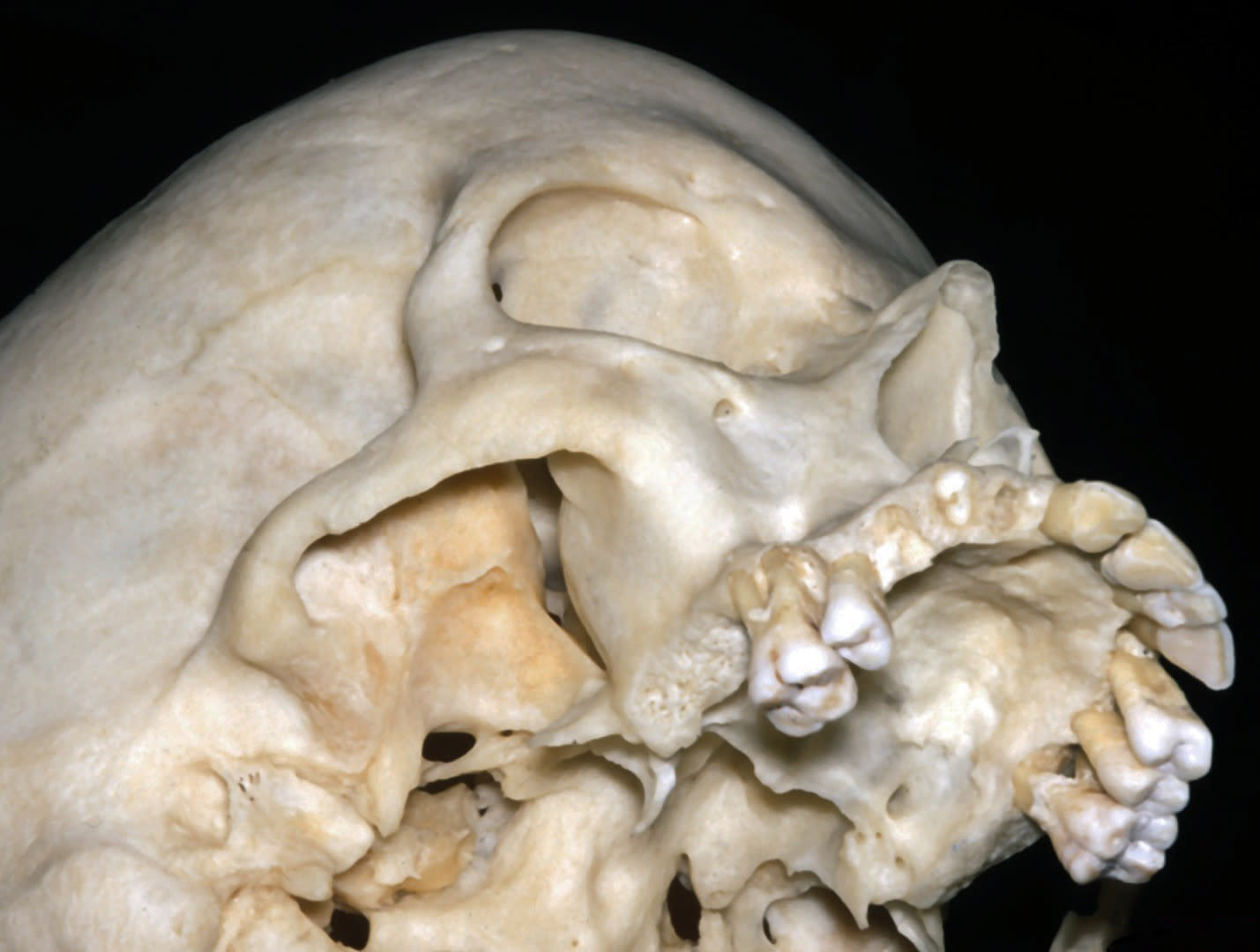 Right Anterolateral Inferior View of Skull | Neuroanatomy | The ...