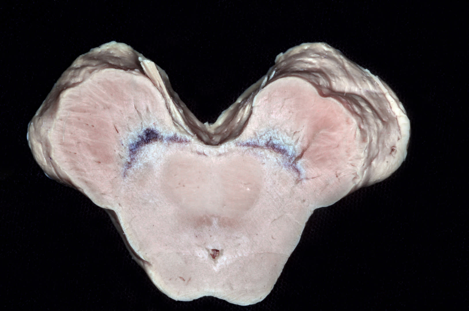 Cross Section of Midbrain | Neuroanatomy | The Neurosurgical Atlas