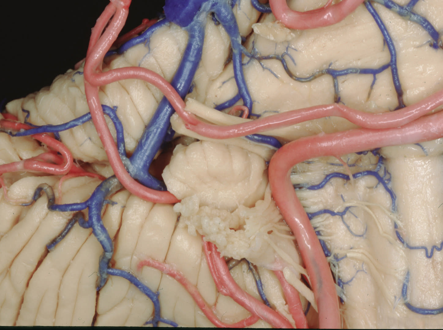 Anterior View of Right Lateral Pons, Medulla, and Cerebellum ...