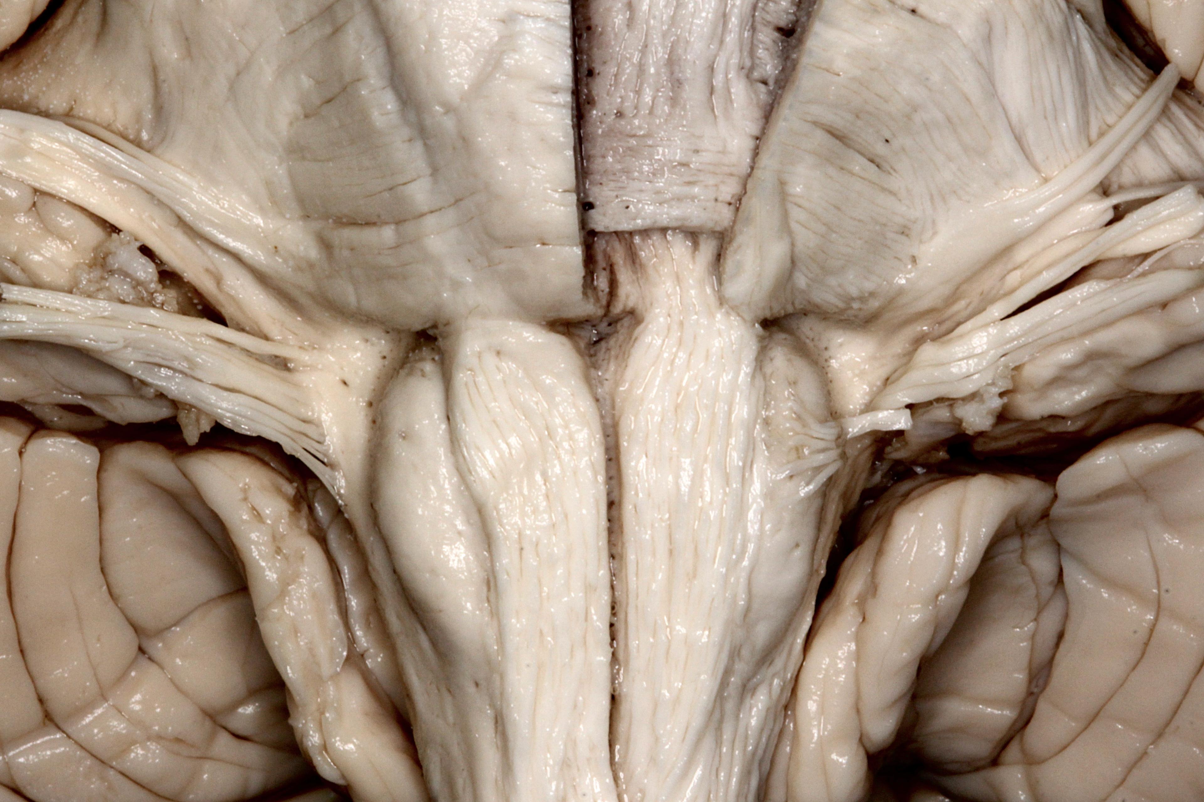 Nerve Fibers at the Pontomedullary Junction | Neuroanatomy | The ...