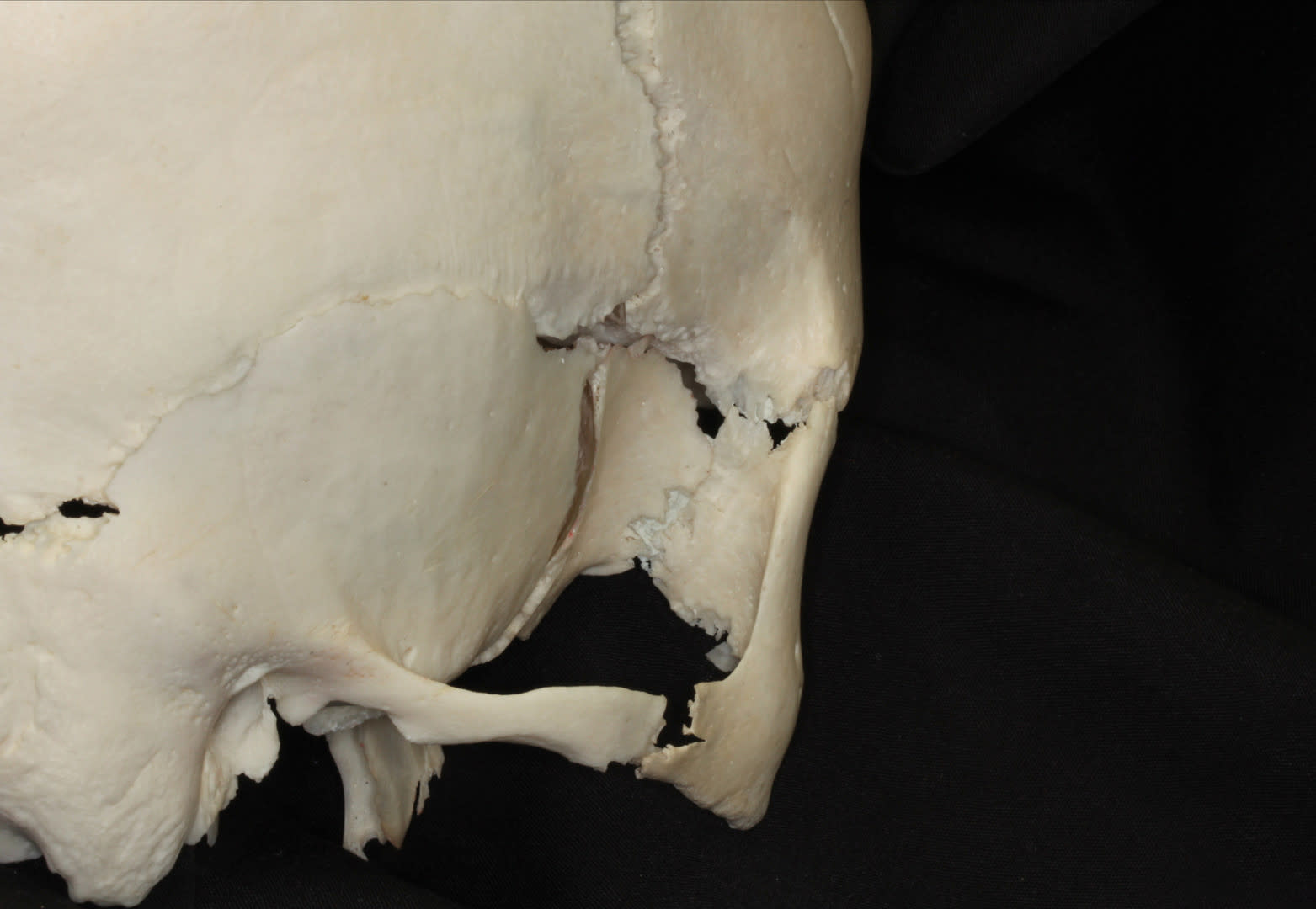 Posterior View of the Temporal Fossa and Pterion | Neuroanatomy | The ...