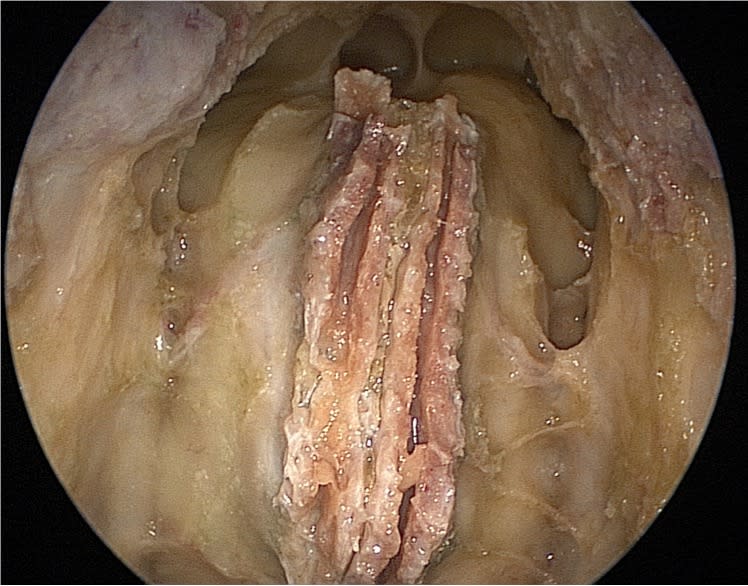 Frontal Sinusotomy | Neuroanatomy | The Neurosurgical Atlas