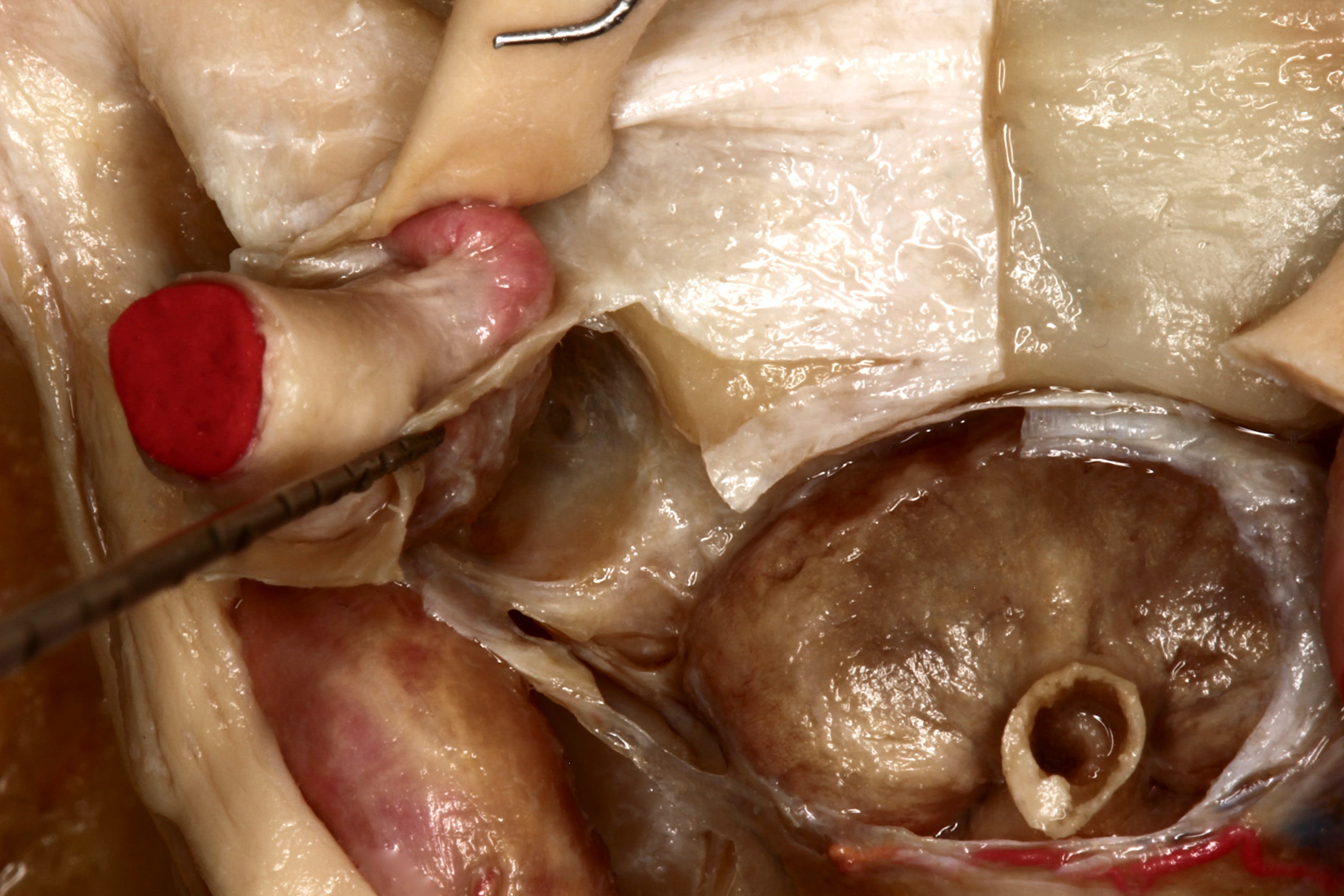 Superior View of Sellar Region | Neuroanatomy | The Neurosurgical Atlas