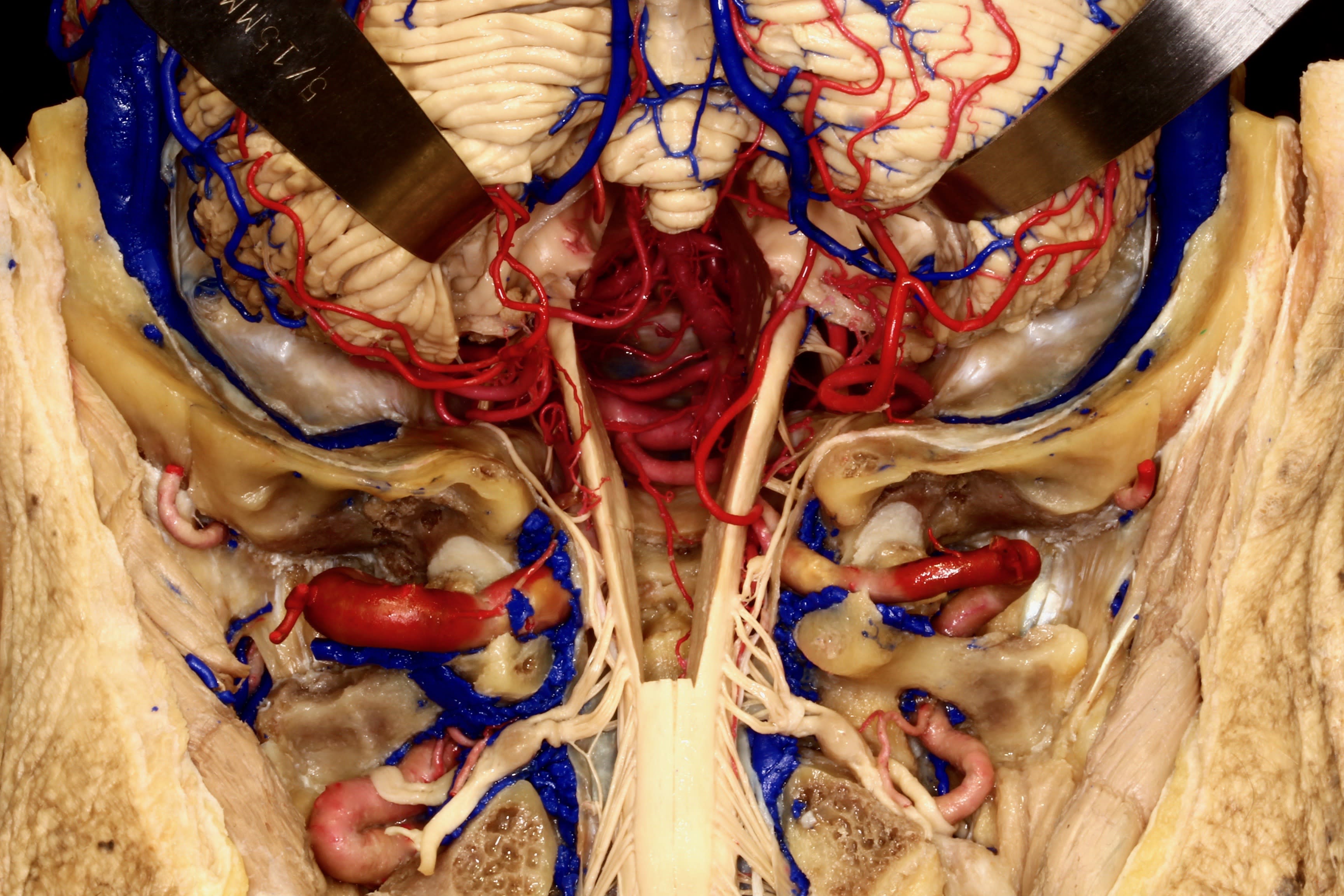 Suboccipital Craniectomy with Cerebellum Retracted | Neuroanatomy | The ...