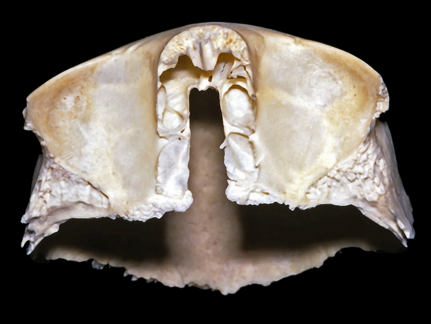 Inferior View of the Frontal Bone | Neuroanatomy | The Neurosurgical Atlas