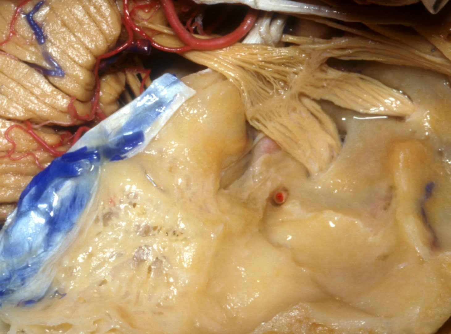 Superior View of Right Middle Fossa and Trigeminal Nerve | Neuroanatomy ...