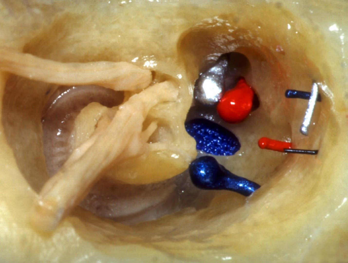 Posterior Oblique View of Fundus of Right Internal Auditory Meatus ...