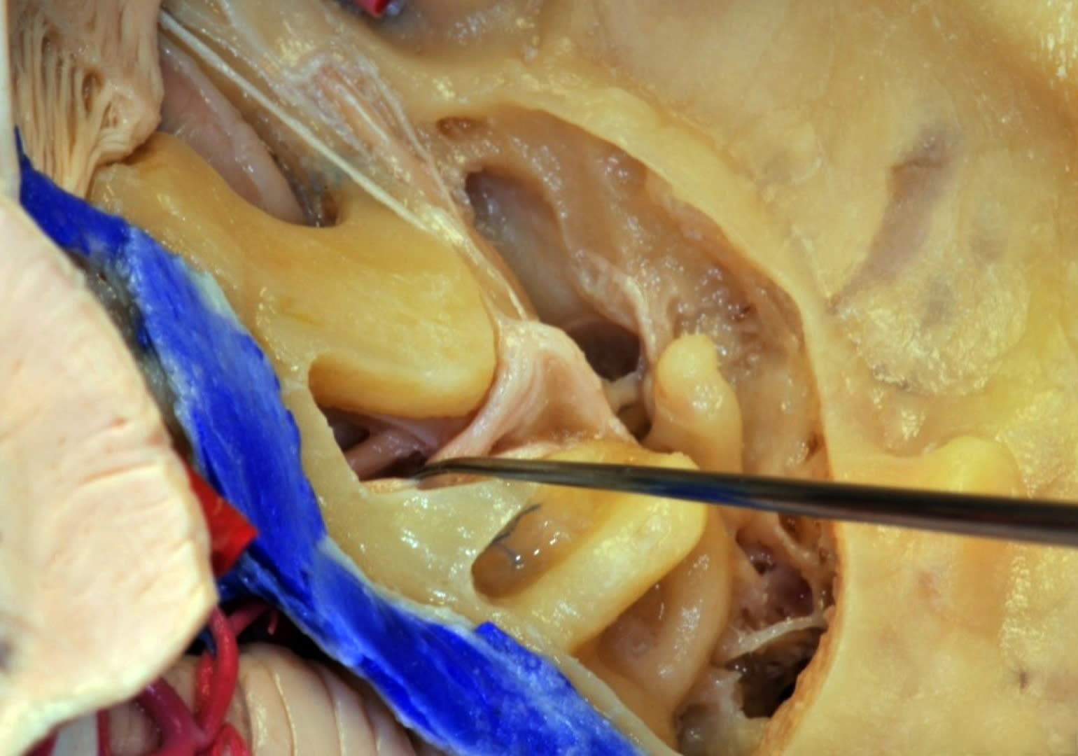 Right Superior View into Fundus of the Internal Auditory Canal with ...