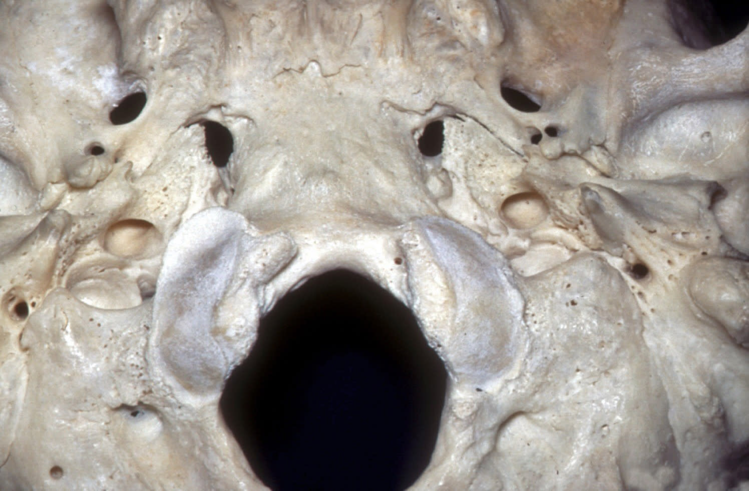 Exocranial Perspective of Posterior Skull Base | Neuroanatomy | The ...