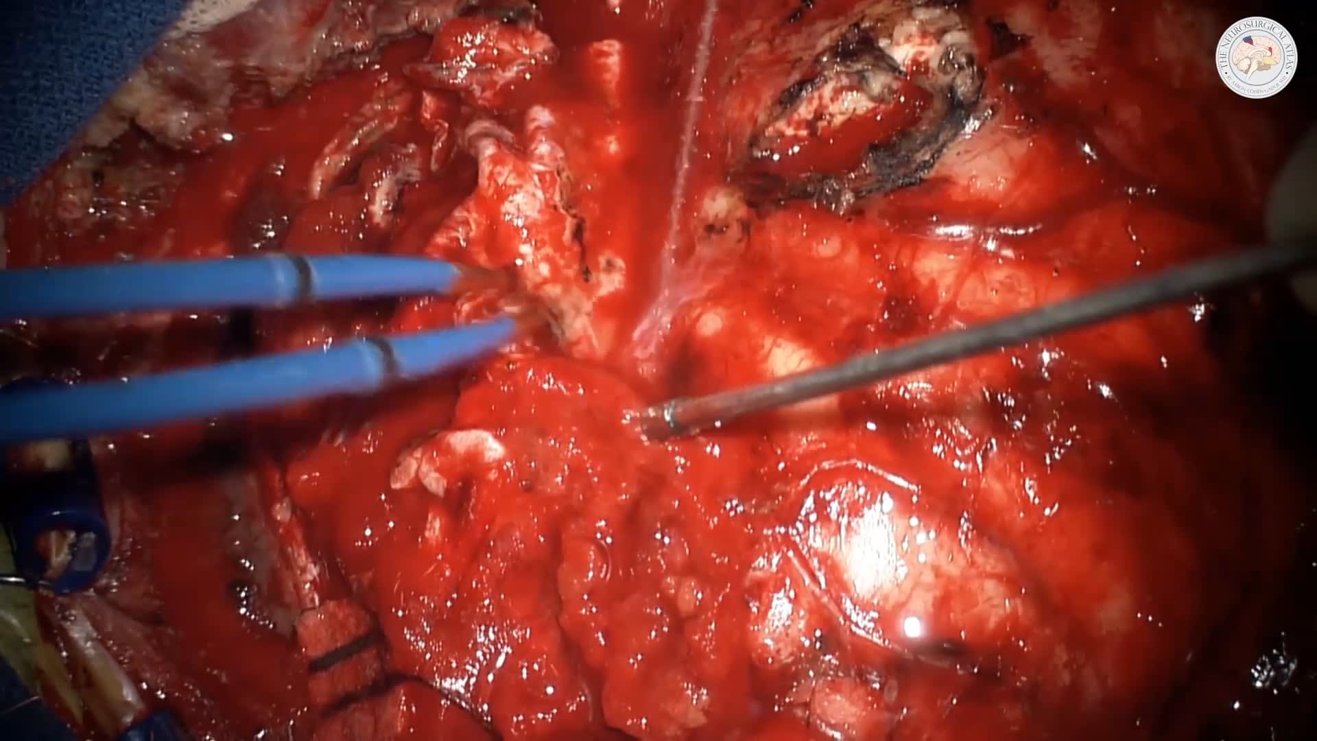 Operative Video Cases | The Neurosurgical Atlas