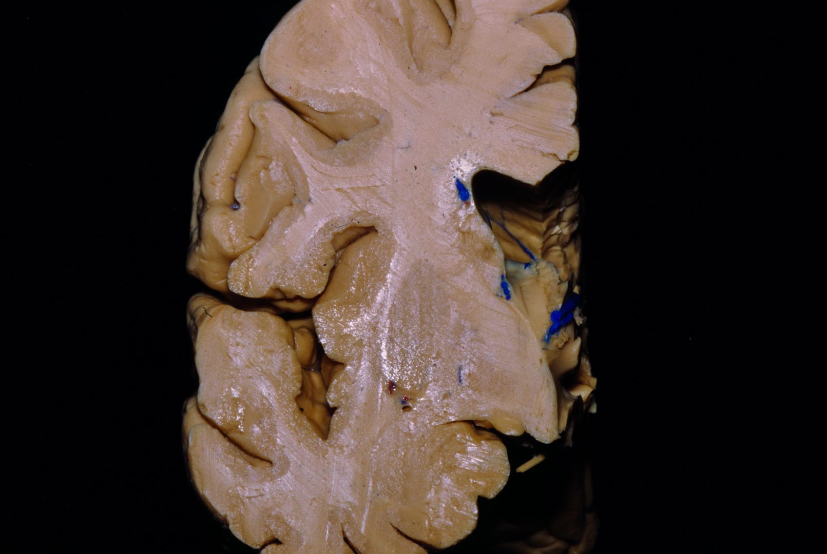 Neuroanatomy | The Neurosurgical Atlas