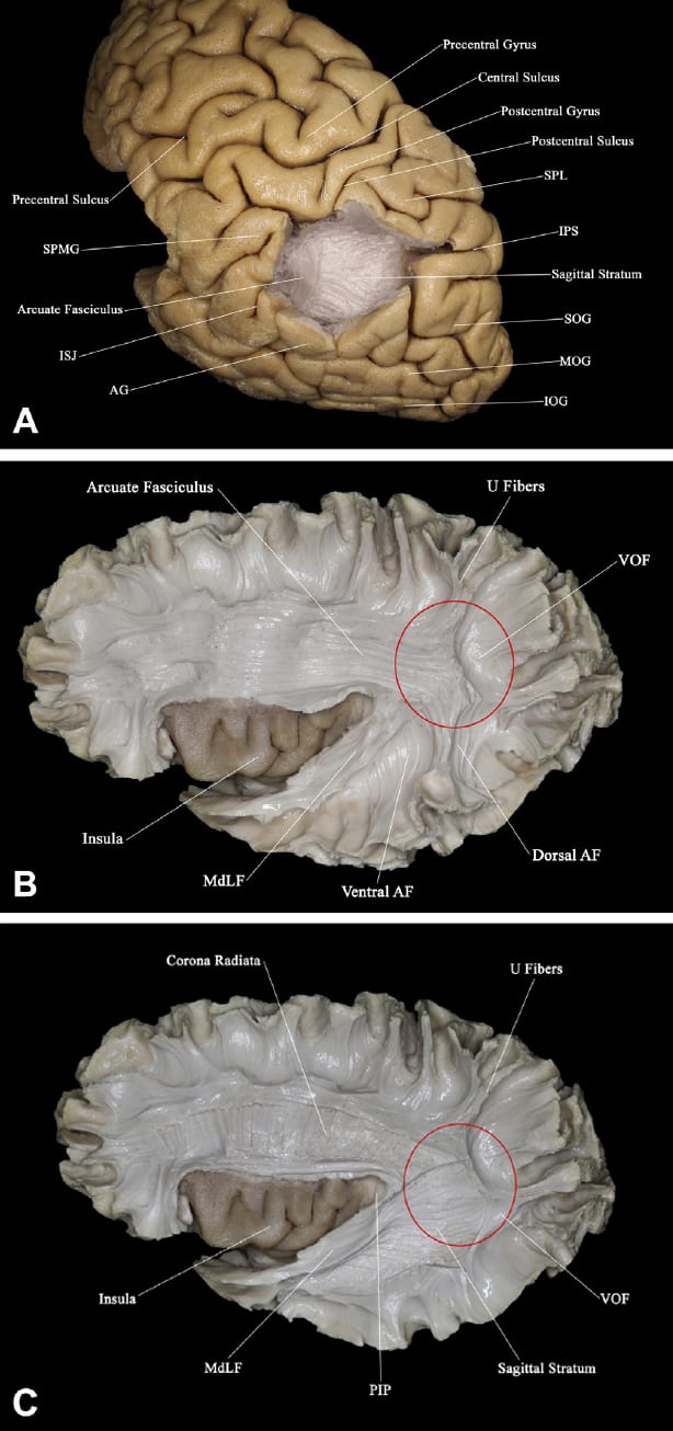 Lateral View of the Brain With a Window Centered at the Level of the ...