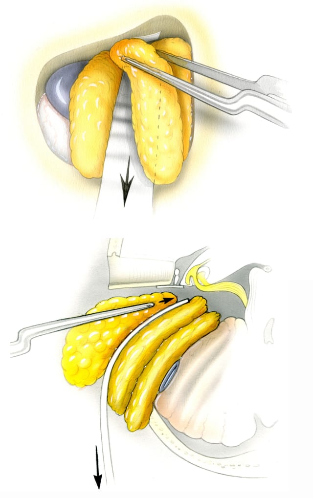 Translabyrinthine | Jackler Collection | Volumes | The Neurosurgical Atlas