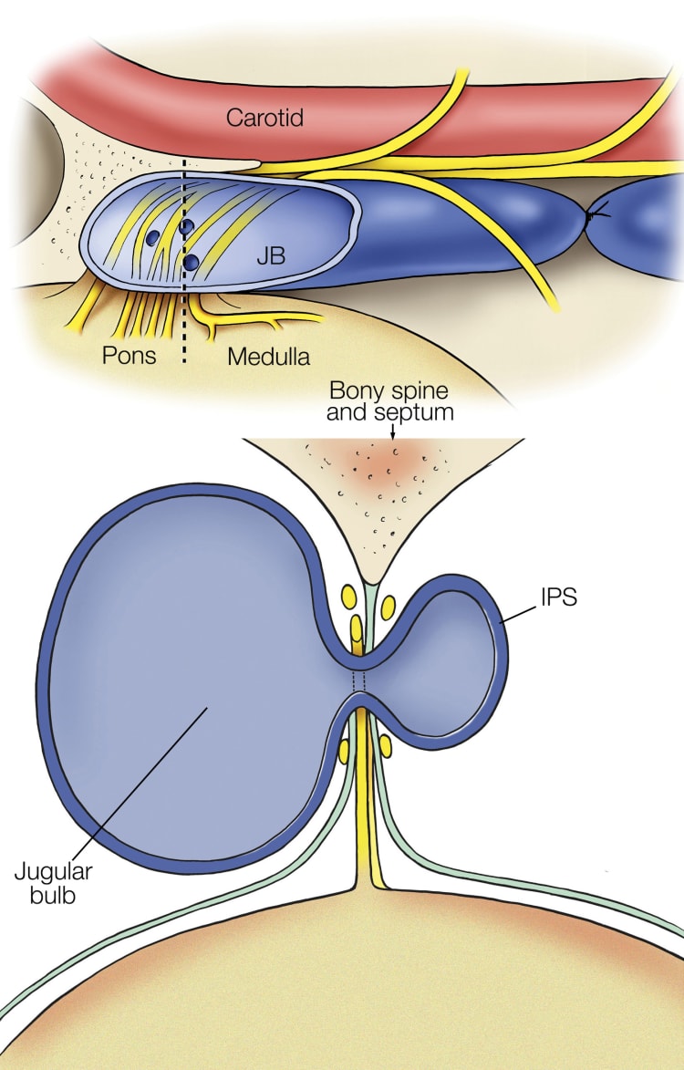 Jugular Foramen Approaches | Jackler Collection | Volumes | The ...
