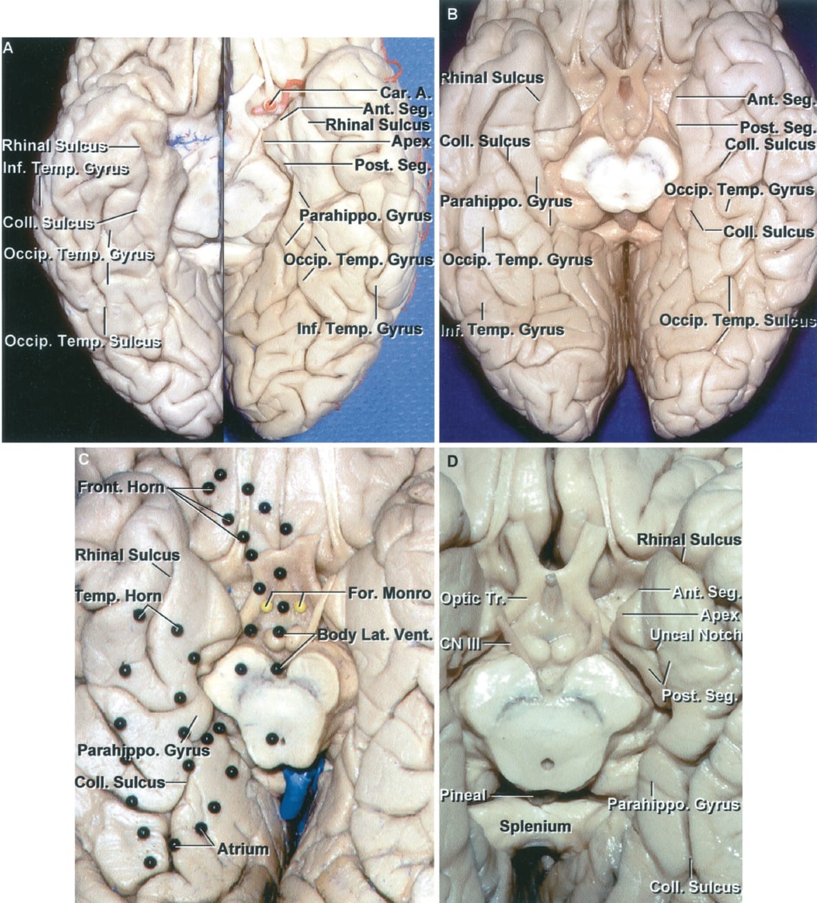 Occipital Lobe Of The Brain The Occipital Lobe W Radiology