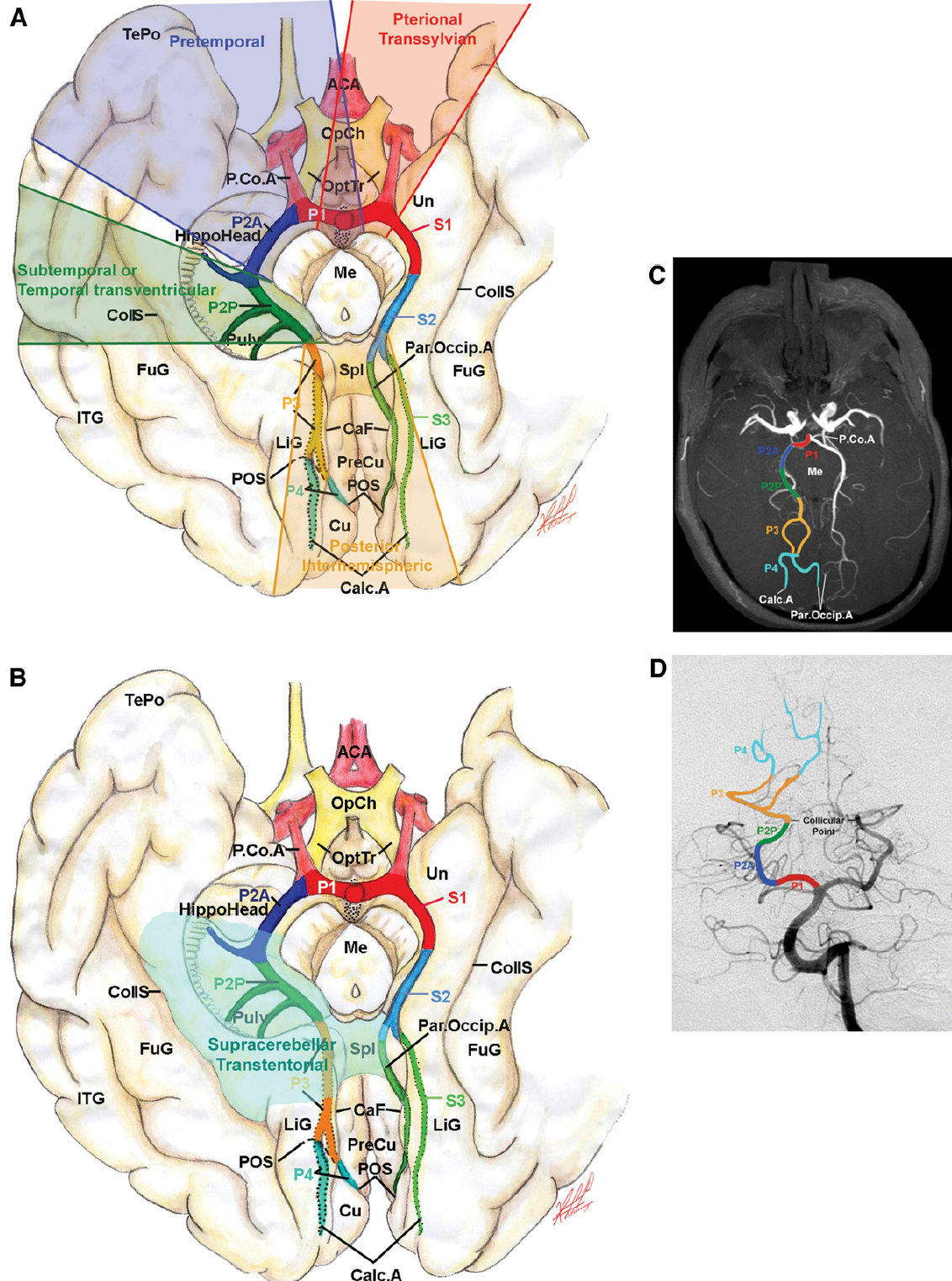 Posterior Cerebral Artery Segments 5 Vascular Abnormalities