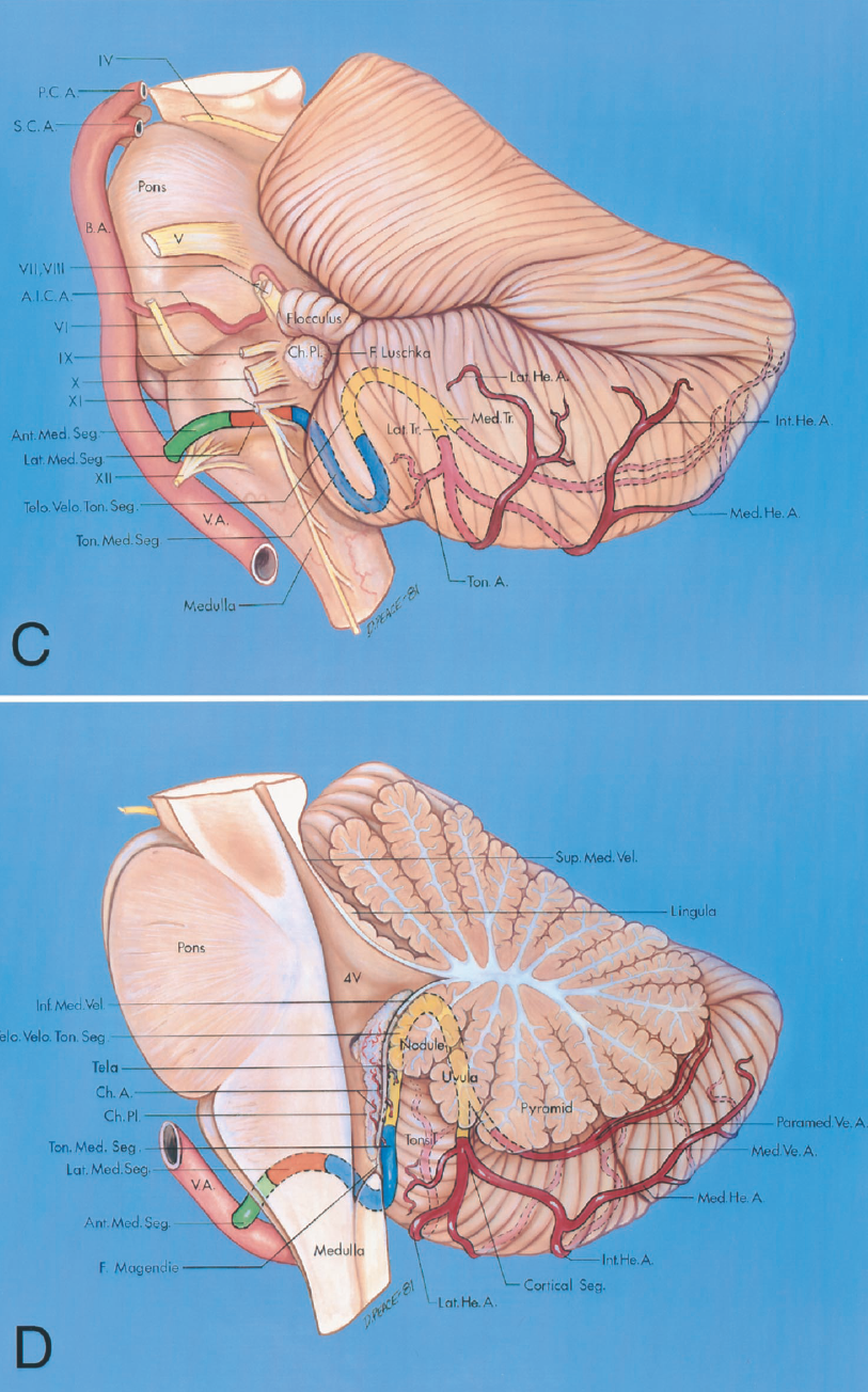 Posterior Inferior Cerebellar Artery Bilateral Extradural Posterior