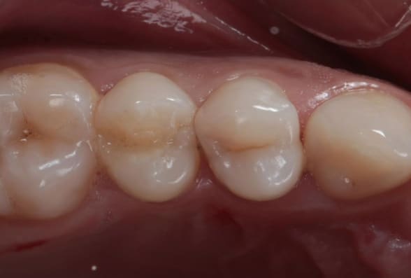 Hidden Proximal Caries Prof. Dr. Alberto Ferreiroa Jacobsen Dental