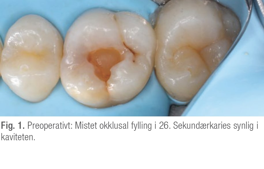 Restaurering av en dyp kavitet Jacobsen Dental