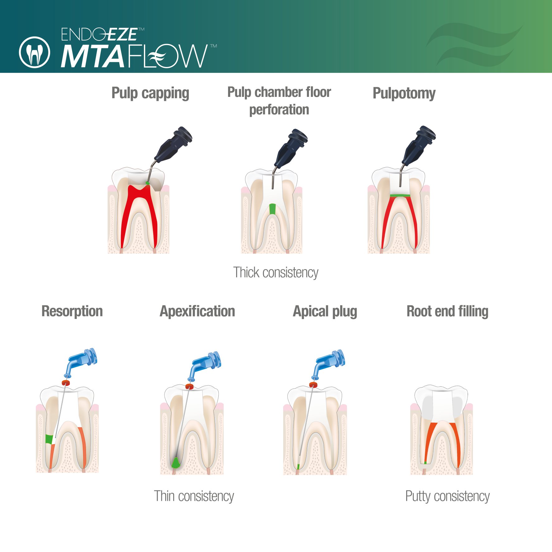 MTAFlow og NaviTip Jacobsen Dental
