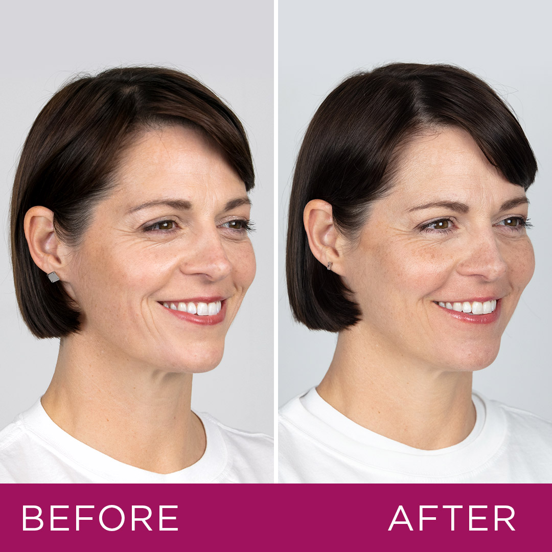 Introducing SCULPTRA. The original biostimulator. | Eden MediSpa ...