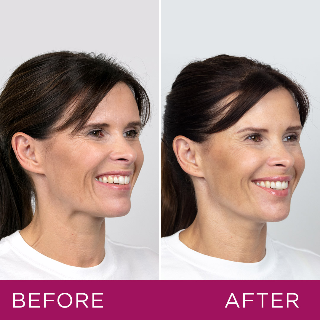 Introducing Sculptra The Original Biostimulator Eden Medispa