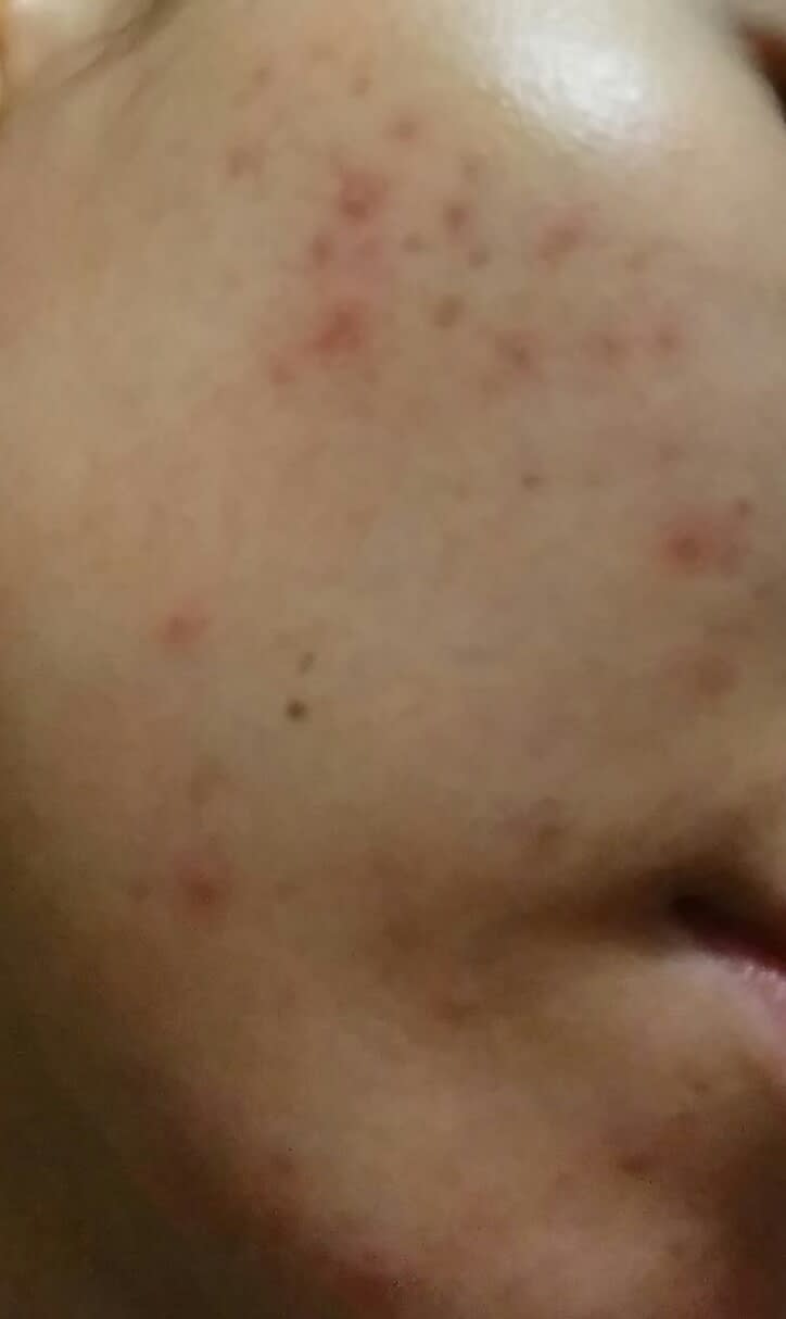 How Do Doctors Determine If Topical Treatments Such As Benzoyl Peroxide how-do-doctors-determine-if-topical-treatments-such-as-benzoyl-peroxide