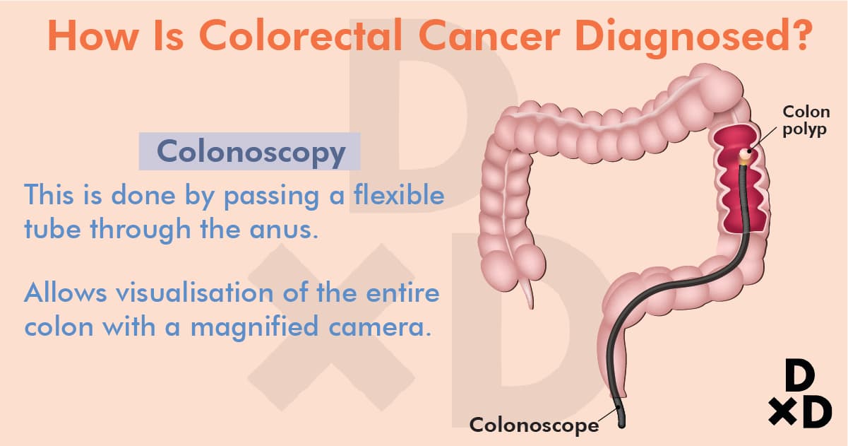 A Comprehensive Guide To Colorectal Cancer In Singapore 2021 Human