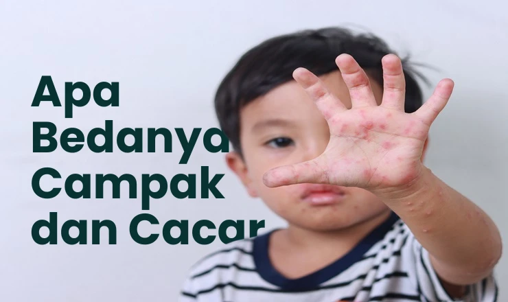 Kenali Ciri-ciri Perbedaan Campak dan Cacar Air